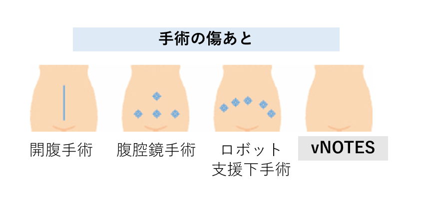 お腹に傷がつかない手術(vNOTES)
